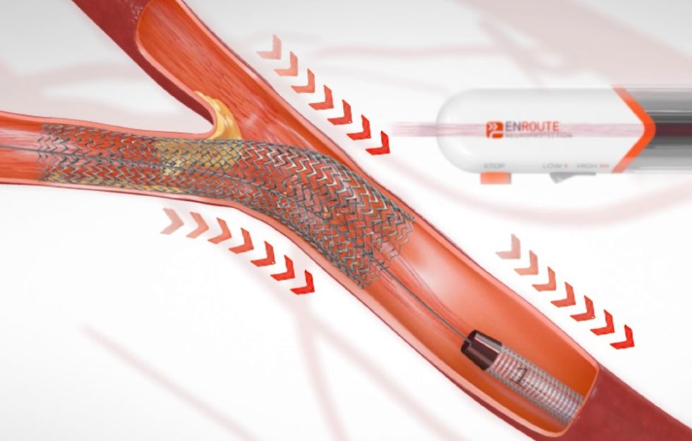 Carotid artery disease | Carotid Artery Stenosis | TCAR Procedure