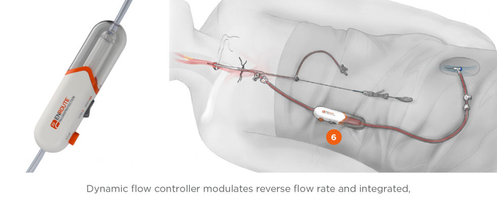 ENROUTE® Transcarotid Neuroprotection System | Silk Road Medical